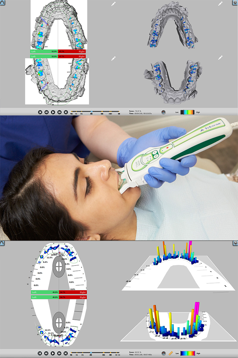 Dental Scan with T-Scan | Tekscan Dental Scan with T-Scan | Tekscan