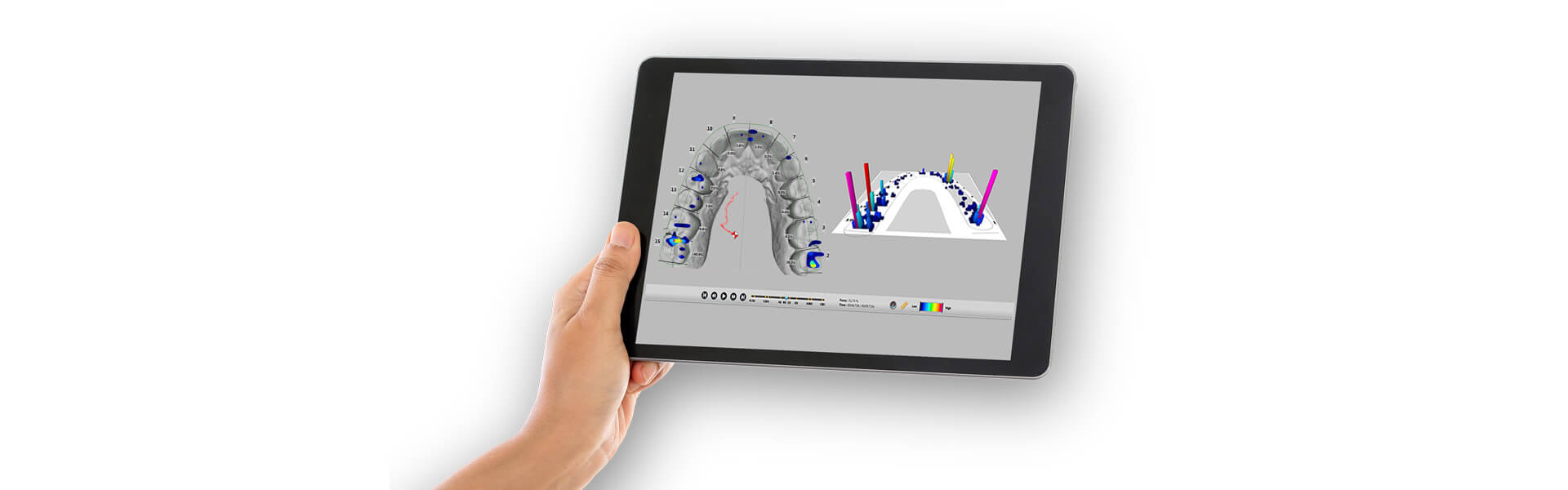 Digital Occlusal Analysis | T-Scan | Tekscan